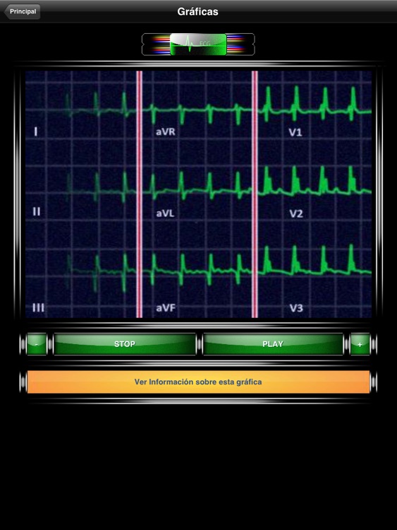 Tipos ECG Electrocardiograma by MIGUEL ANGEL GARCIA VAZQUEZ