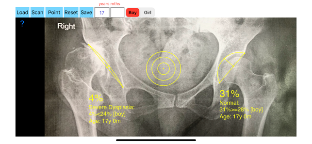 ‎App Store에서 제공하는 AcetabularDepthRatioApp