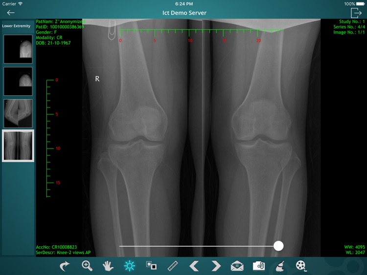 hinAI HD by ICT HEALTH