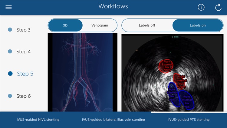Philips Venous IVUS Tutor by Philips Electronics North America Corporation